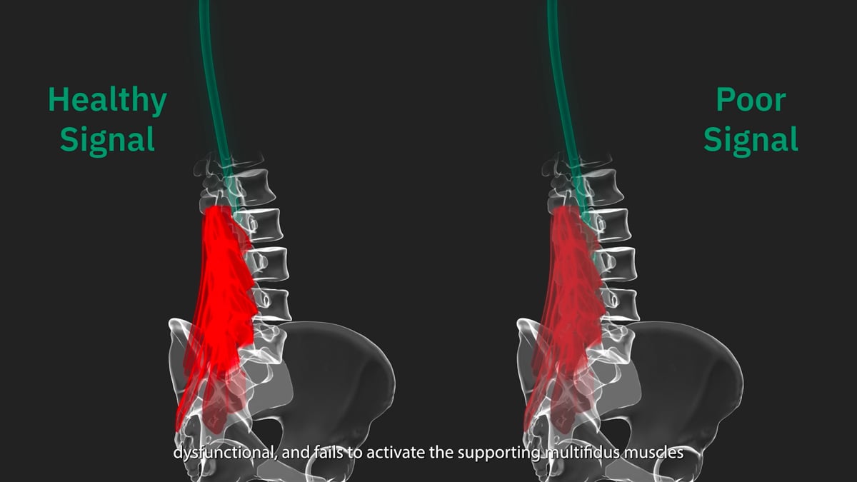 Why does multifidus dysfunction cause low back pain?