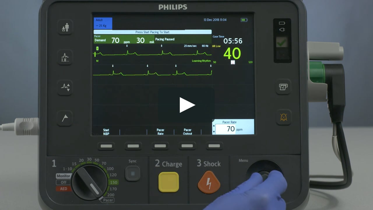 6 - NonInvasive Transcutaneous Pacing with the HeartStart Intrepid ...