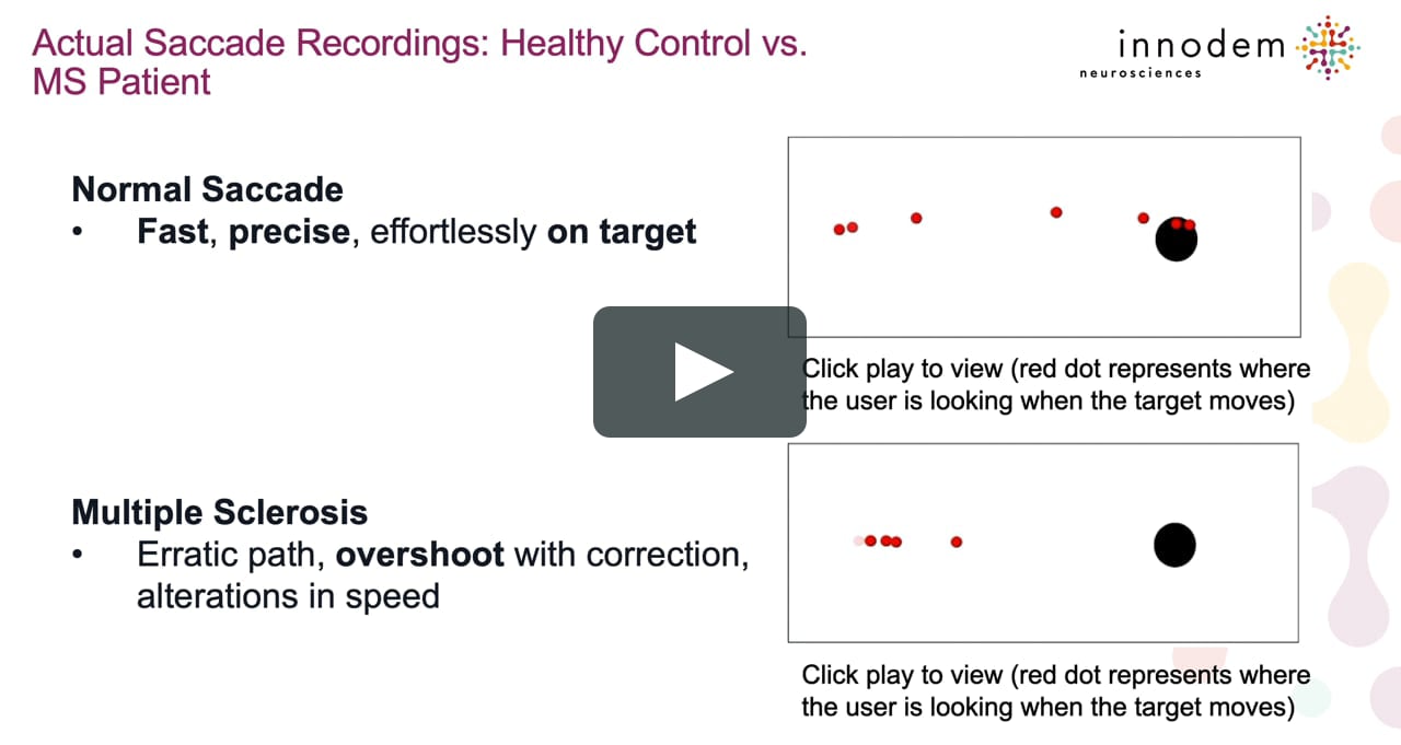 Saccade Profile Normal vs. MS on Vimeo
