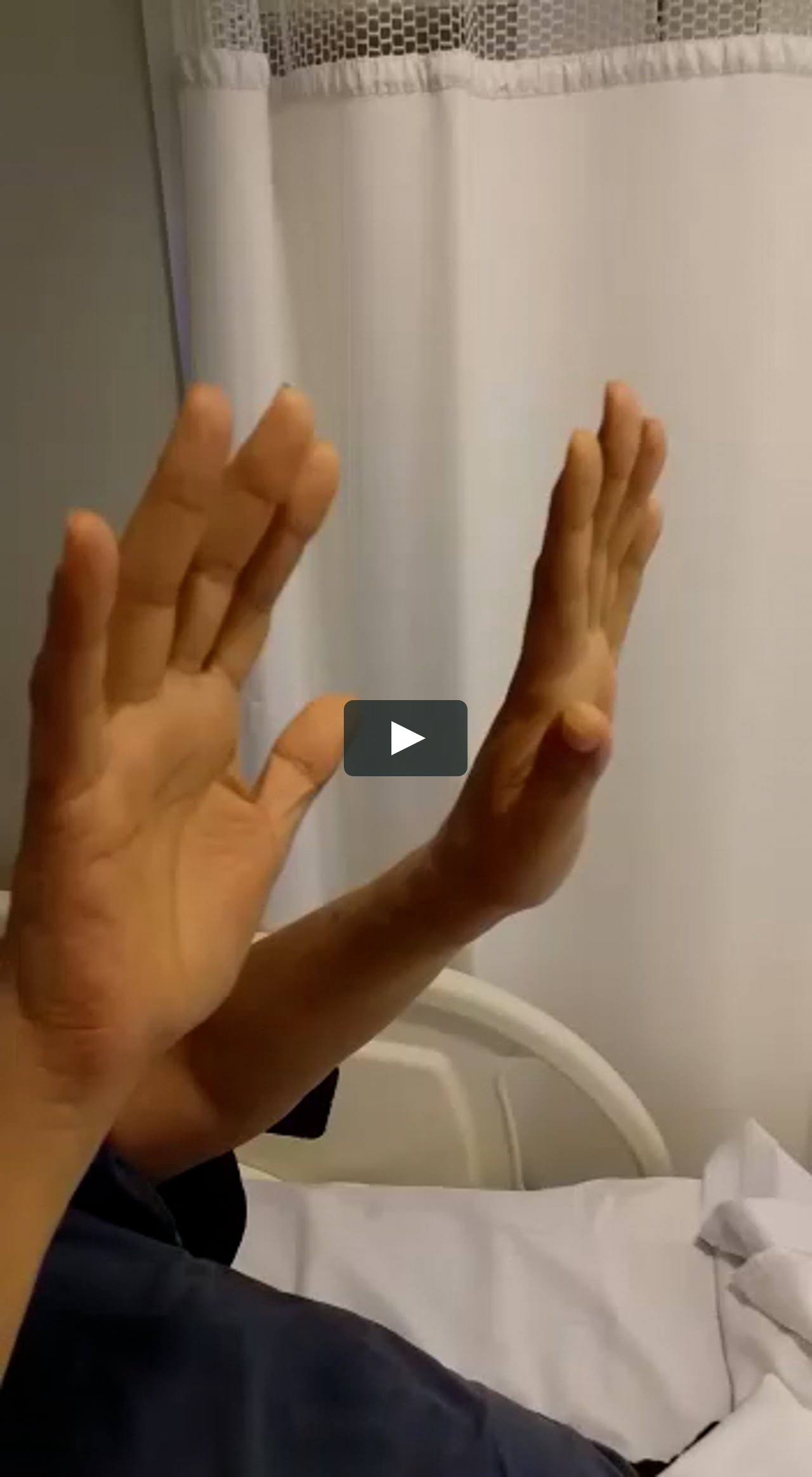 Asterixis/flapping (cirrosis) on Vimeo