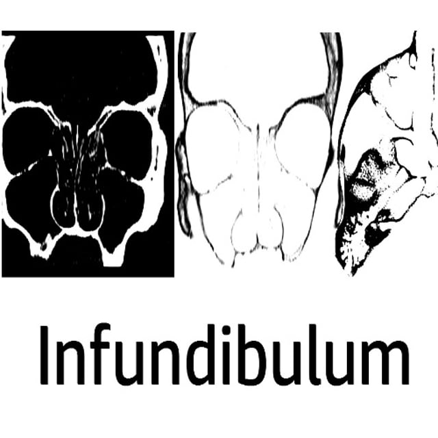 infundibulum