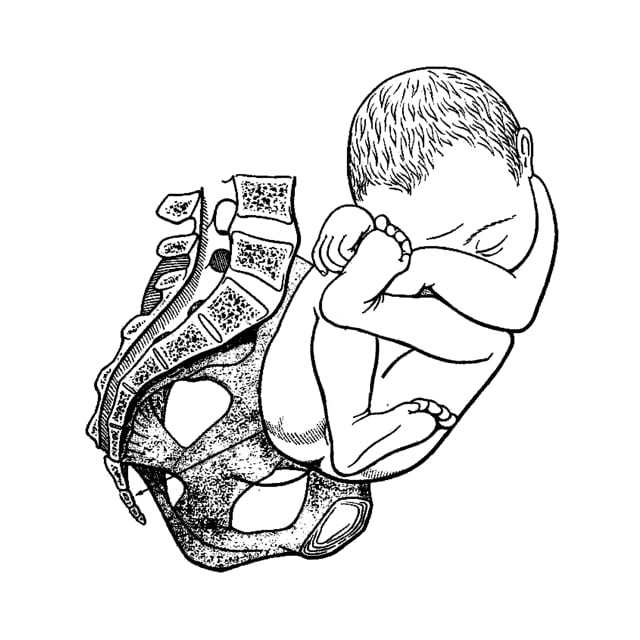 Breech Without Borders