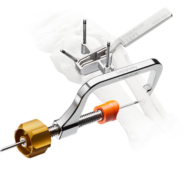 Treace Medical Concepts