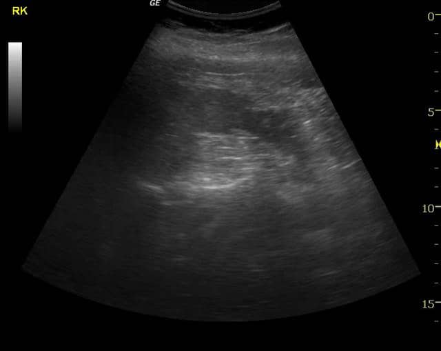 PUJ stone, Hydronephrosis on Vimeo