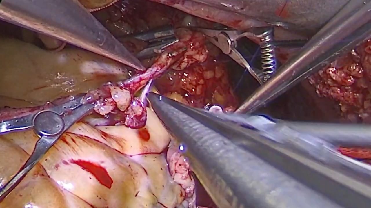Total coronary revascularization via left anterior thoracotomy ...