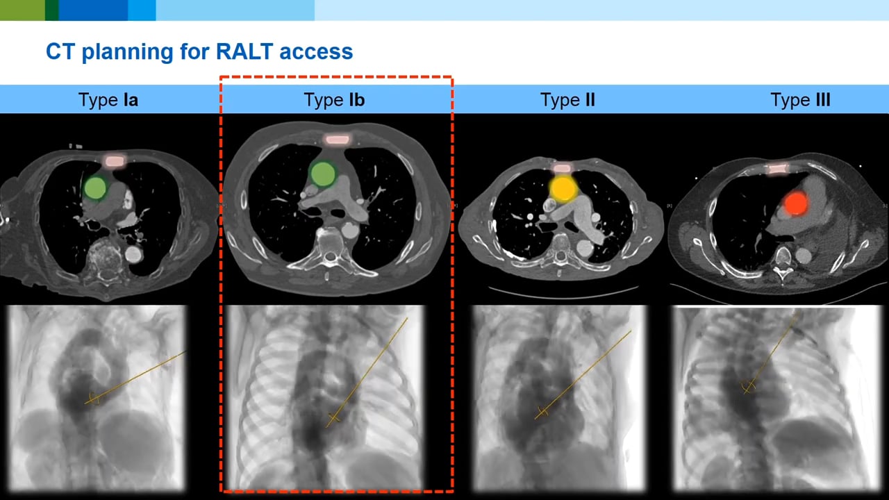 Minimally invasive surgical aortic valve replacement through a right ...