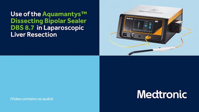 Use of the Aquamantys DBS 8.7 in Laparoscopic Liver Resection in ...