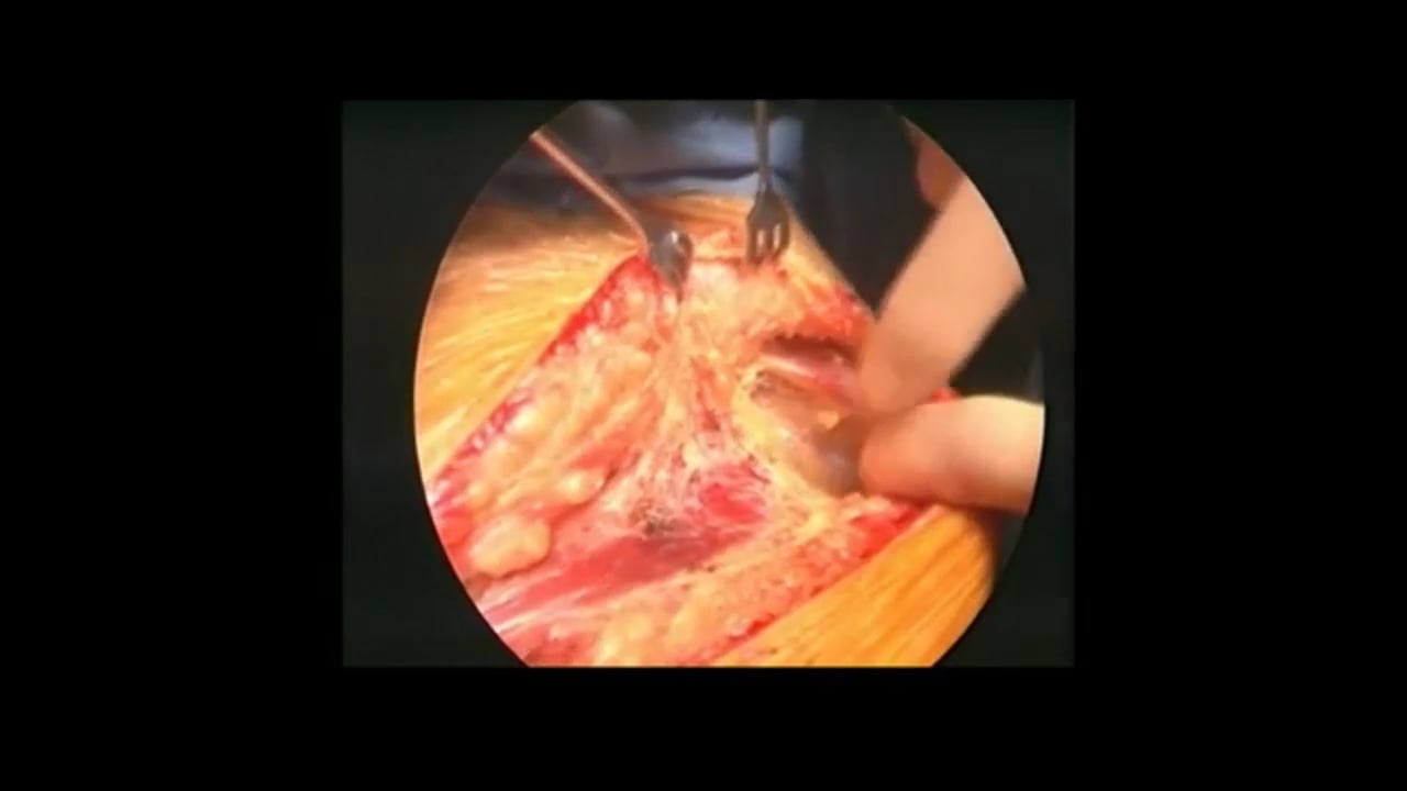 Axillary thoracotomy | MMCTS