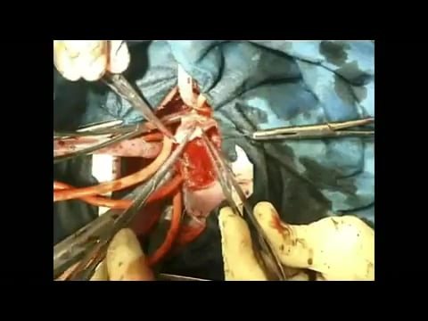 Surgery for malposition of the great arteries: the REV procedure | MMCTS