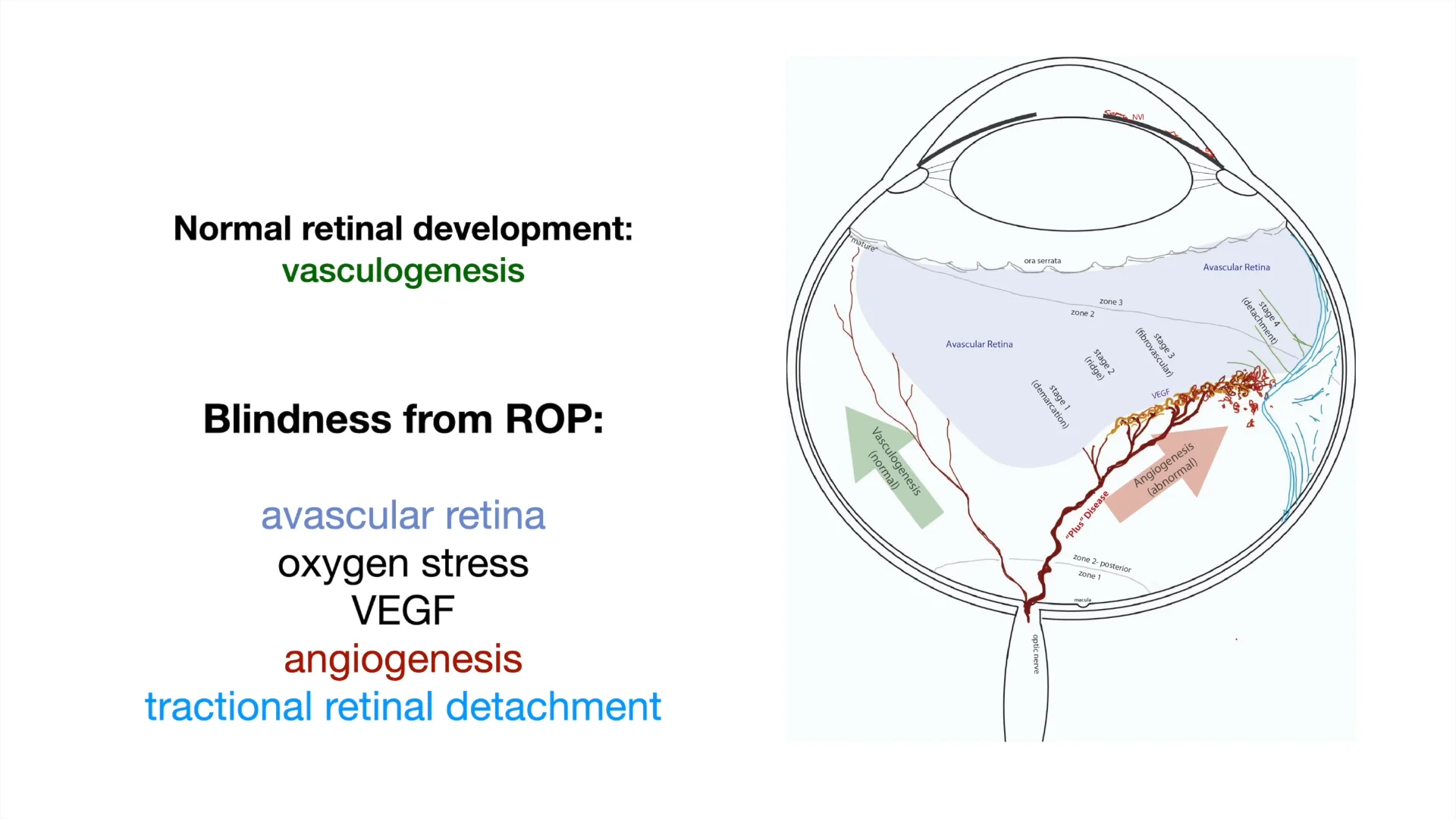 ROP Pathophysiology and Treatment on Vimeo