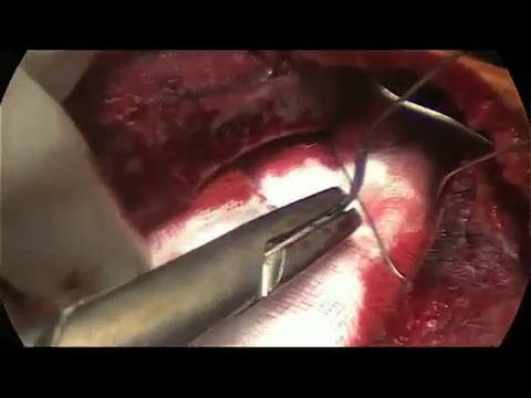 Median sternotomy | MMCTS