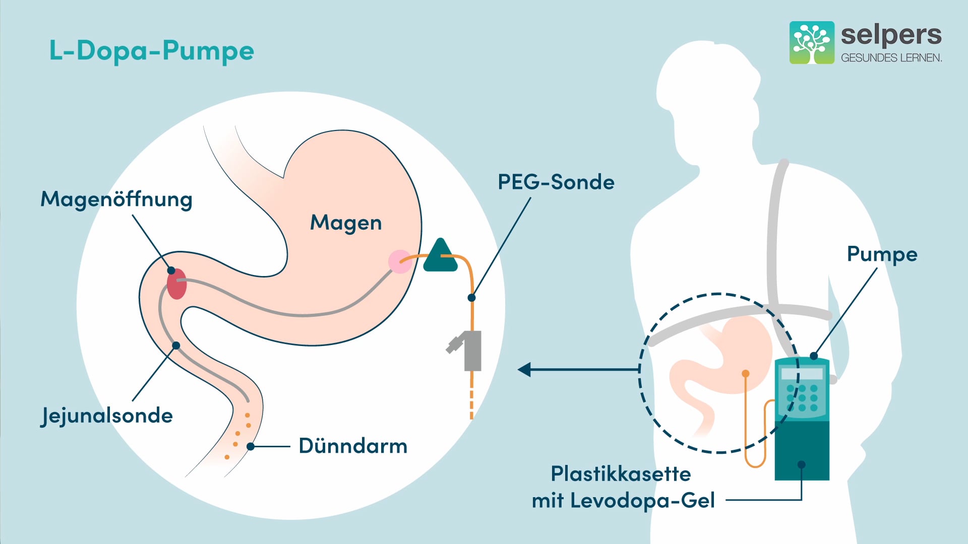 Levodopa-Pumpe bei fortgeschrittenem Morbus Parkinson on Vimeo