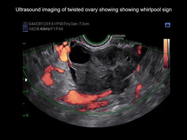 Ovarian Torsion Ultrasound Whirlpool Sign