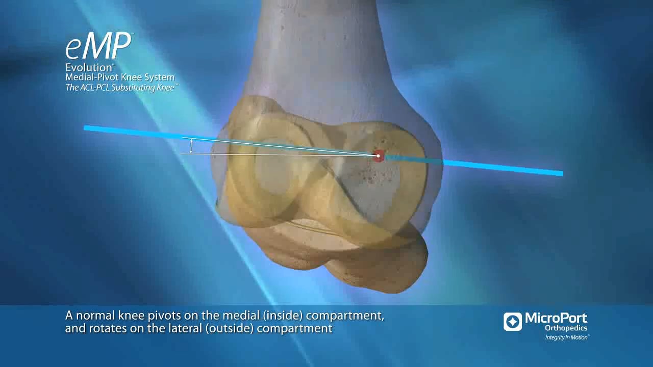 MicroPort Orthopedics Medial Pivot Knee eMP™-Normal-Knee-Pivots-on ...