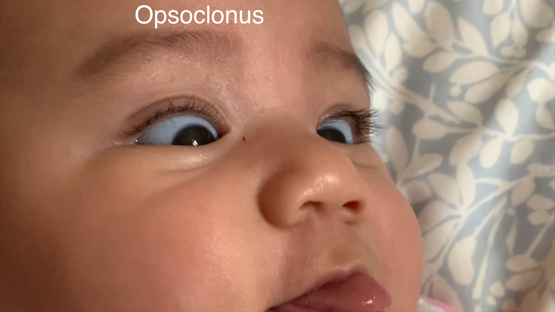 Opsoclonus after COVID-19 in an infant on Vimeo