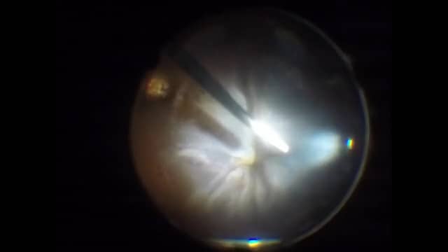 Combined Phaco Vitrectomy for a Open Funnel Retinal Detachment on Vimeo