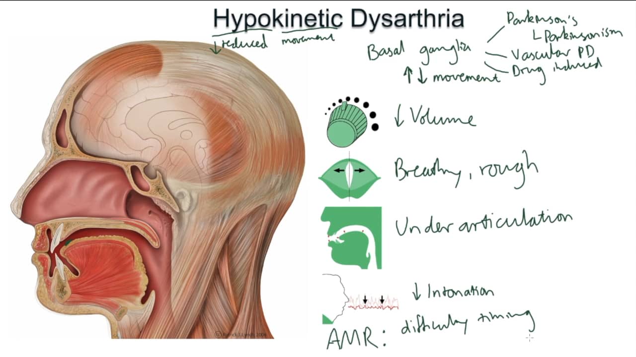Hypokinetic Dysarthria - examples and tutorial on Vimeo
