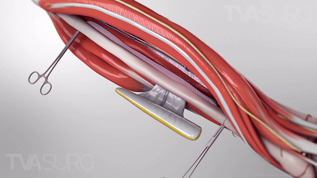 ENT Fibula Osteocutaneous Flap preview on Vimeo