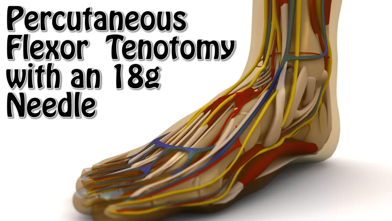 PC FDL Tenotomy on Vimeo