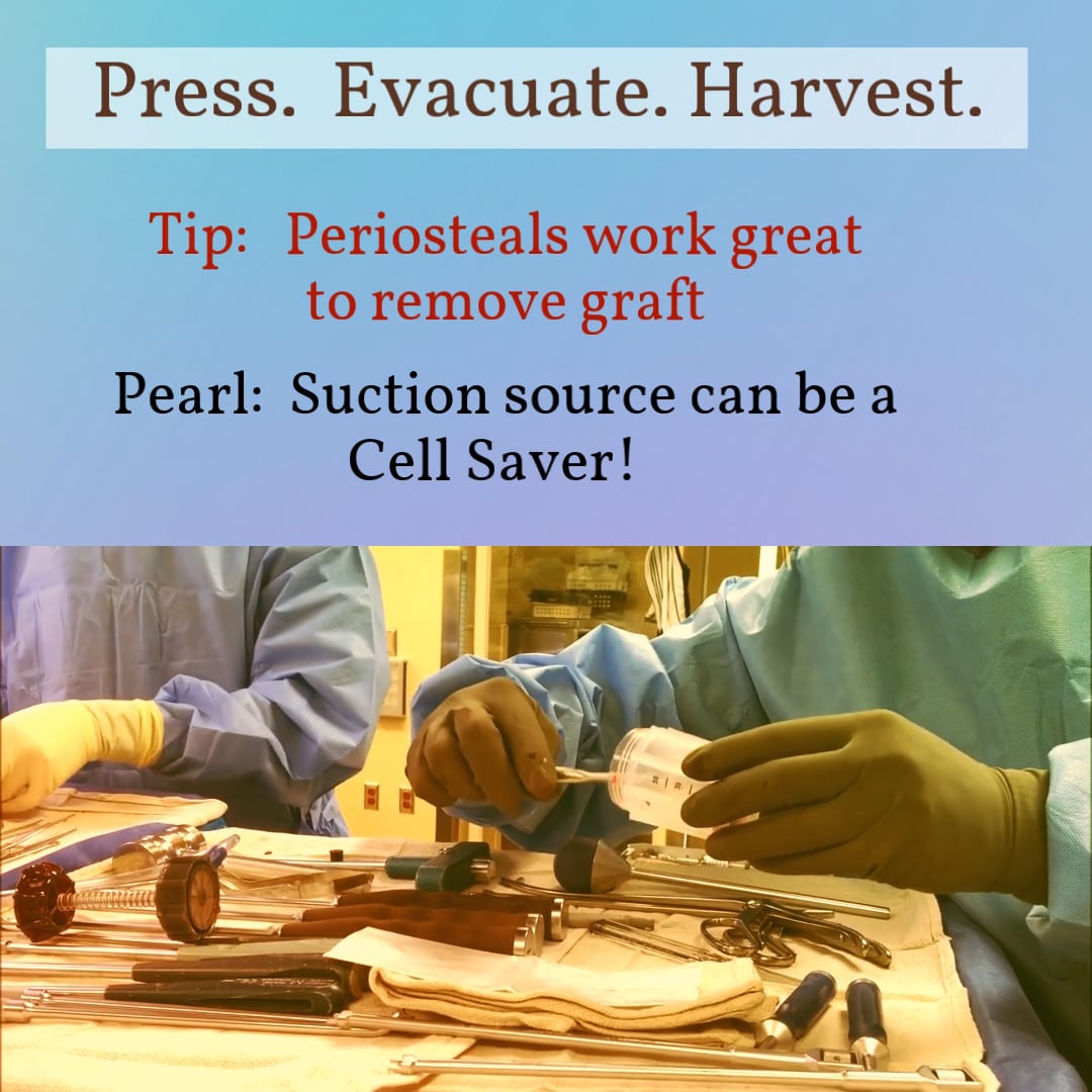 Aytograft Harvesting - Hensler Bone Press 2021 on Vimeo