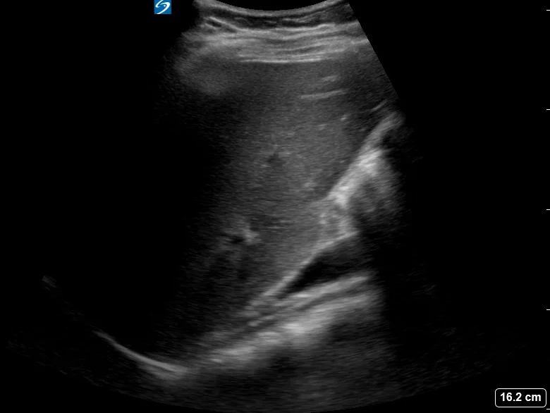 Gallbladder Full of Stones2 (+Wall Echo Shadow (WES) Sign)