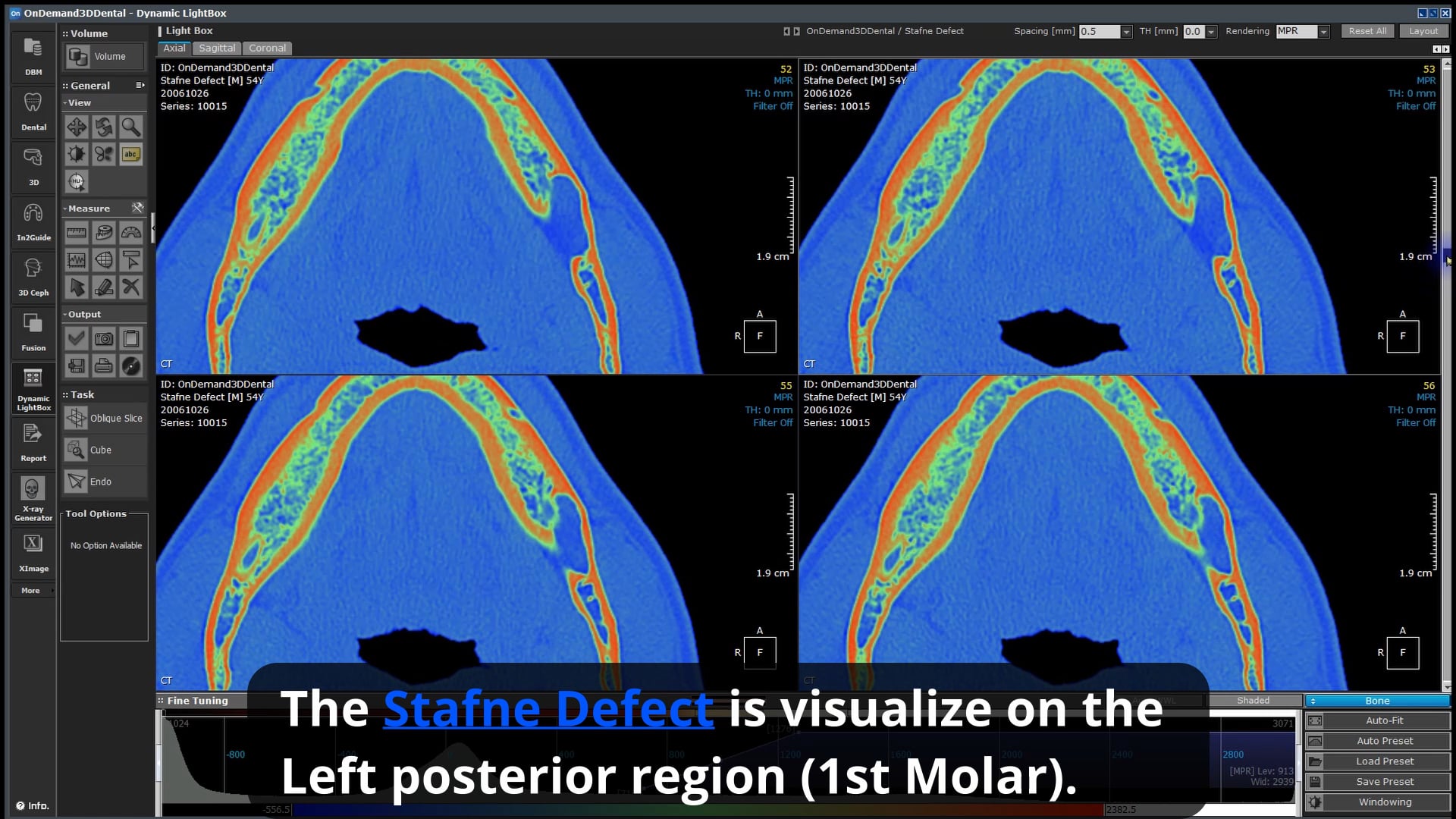 Dynamic Lightbox(Stafne Defect)case on Vimeo