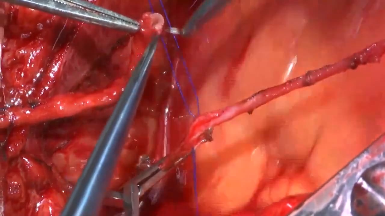 Composite LITA-RITA-Y (“LIMA-RIMA-Y”) graft configuration for coronary ...