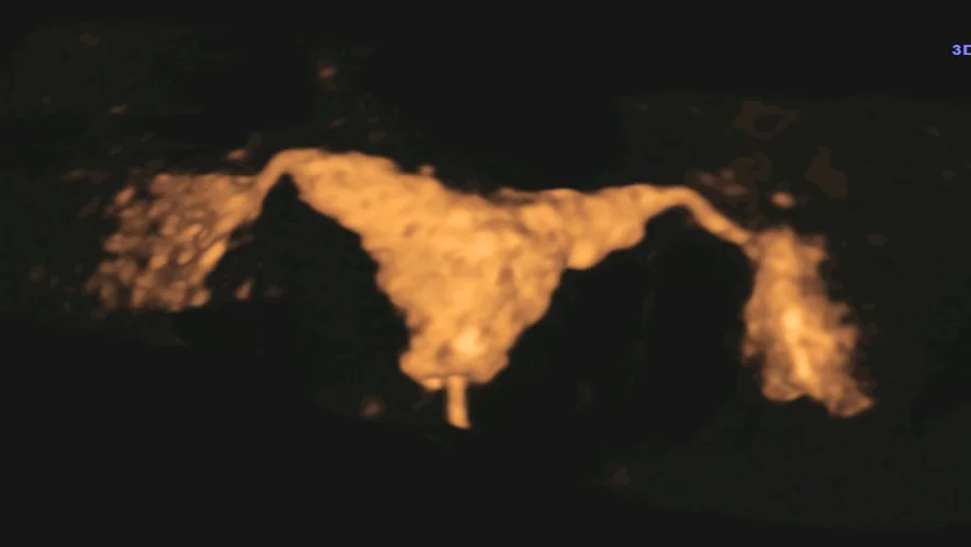 The Science behind ExEm® Foam - HyFoSy 3D ultrasound