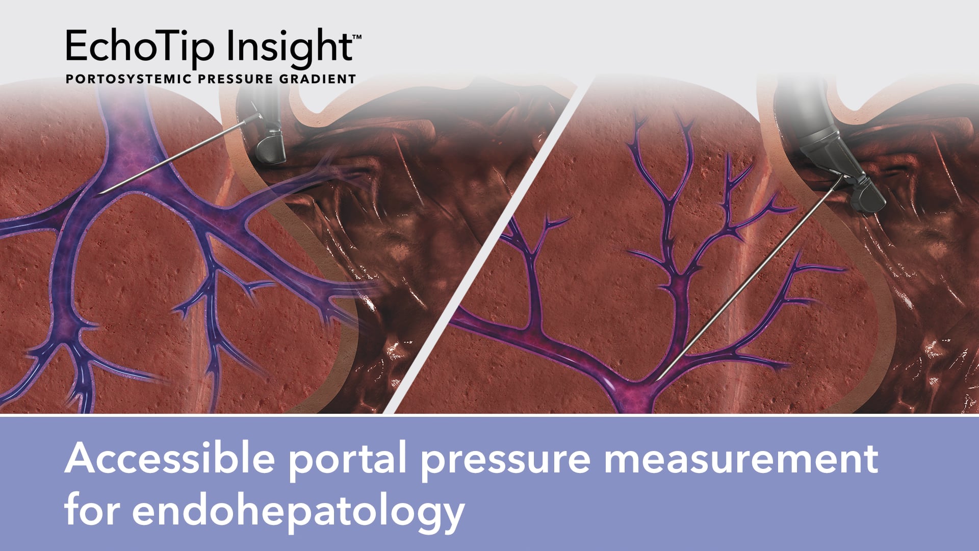 Cook Medical EchoTip Insight Portosystemic Pressure Gradient on Vimeo