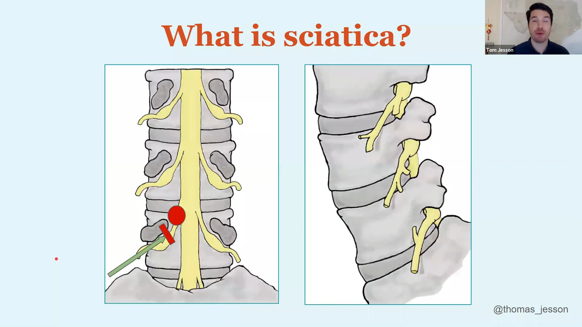 Tom Jesson Sciatica: What it is, and what to do about it? on Vimeo