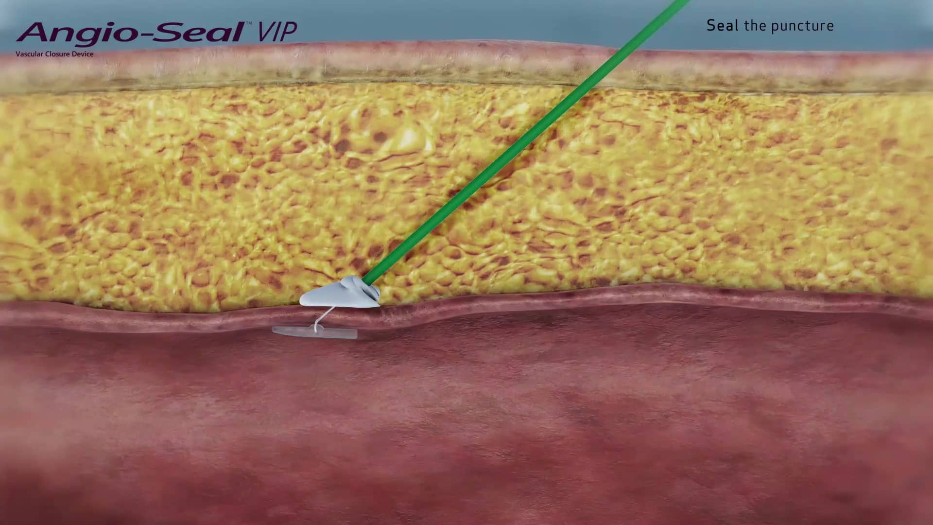 Angio-Seal_VIP on Vimeo