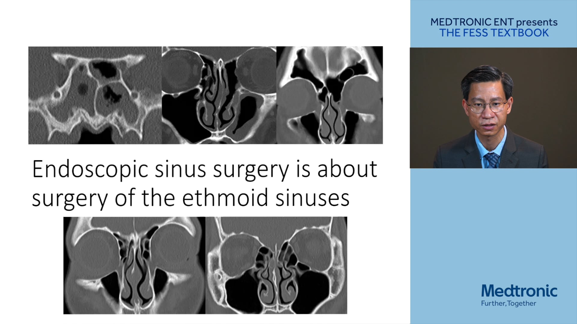 3 Anterior Ethmoidectomy, Posterior Ethmoidectomy and Sphenoid Sinus ...