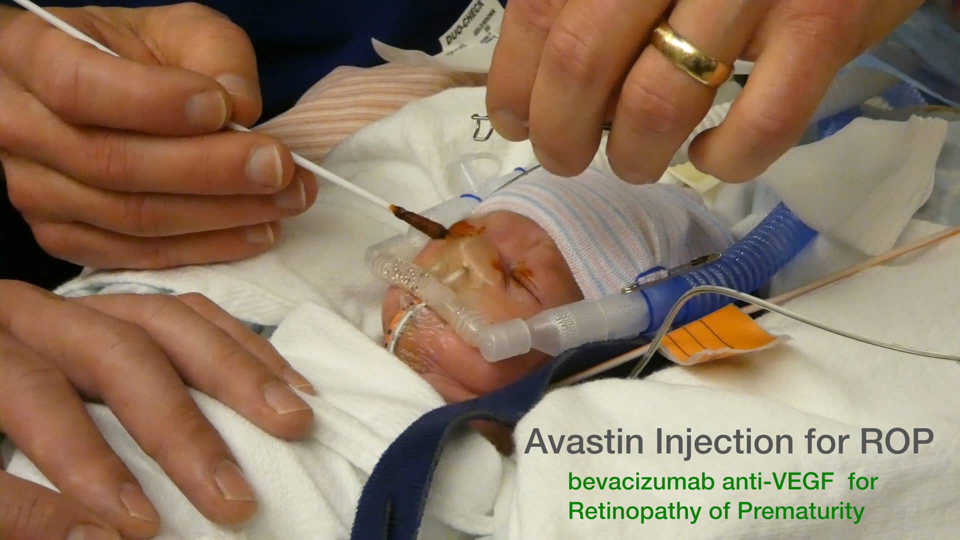 Avastin for ROP on Vimeo