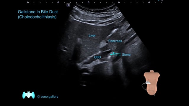 Choledocholithiasis Ultrasound