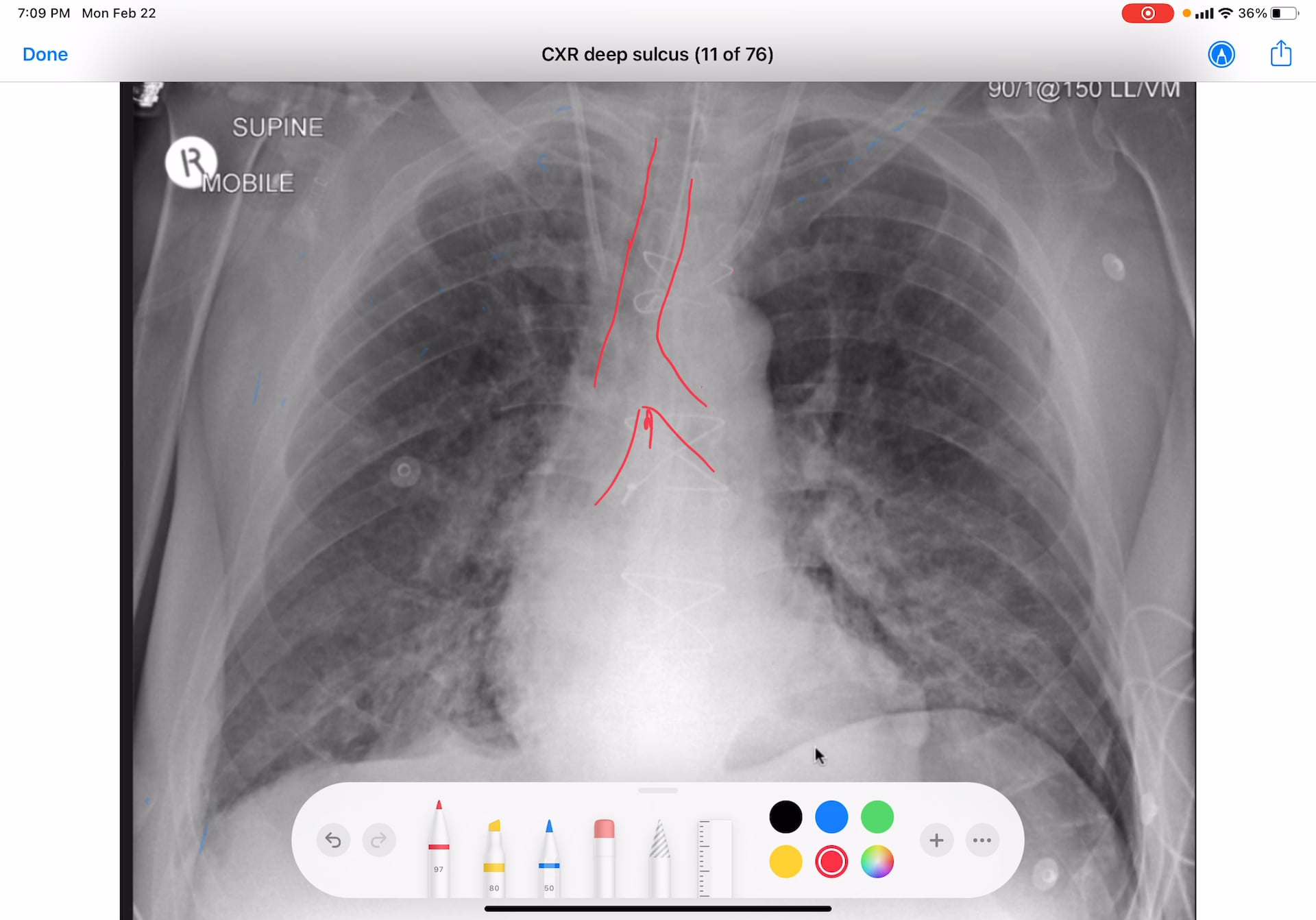 CXR Deep Sulcus sign on Vimeo