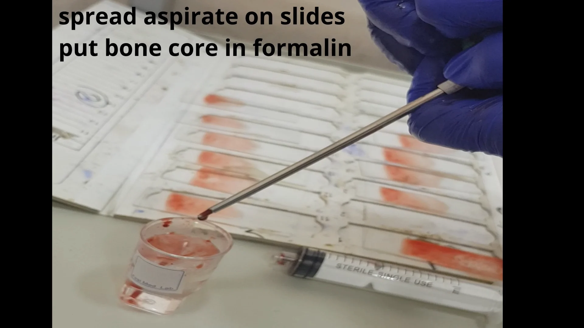 bone marrow aspiration and biopsy procedure