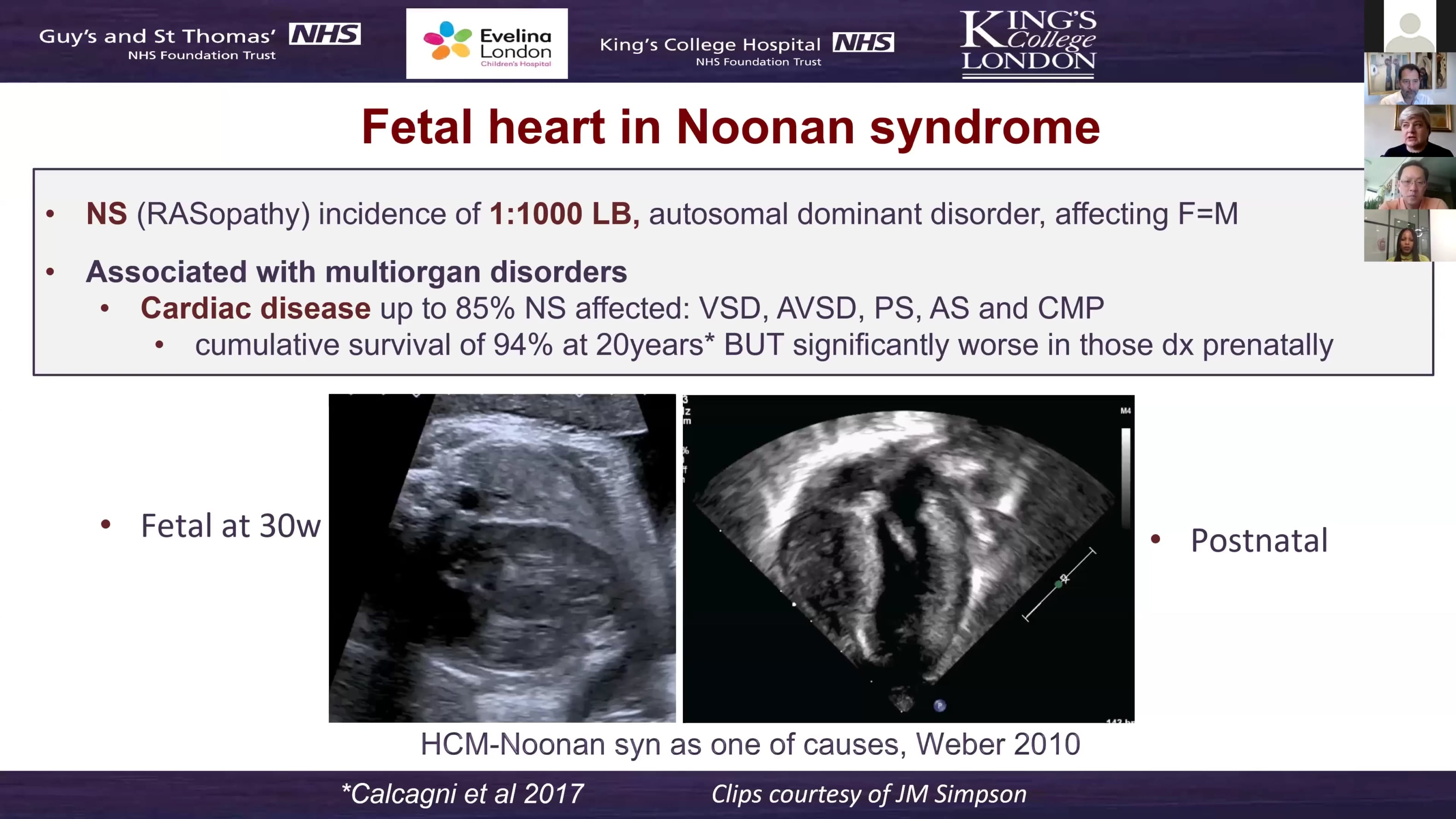 Noonan syndrome: cardiac findings by Vita Zidere (UK) on Vimeo