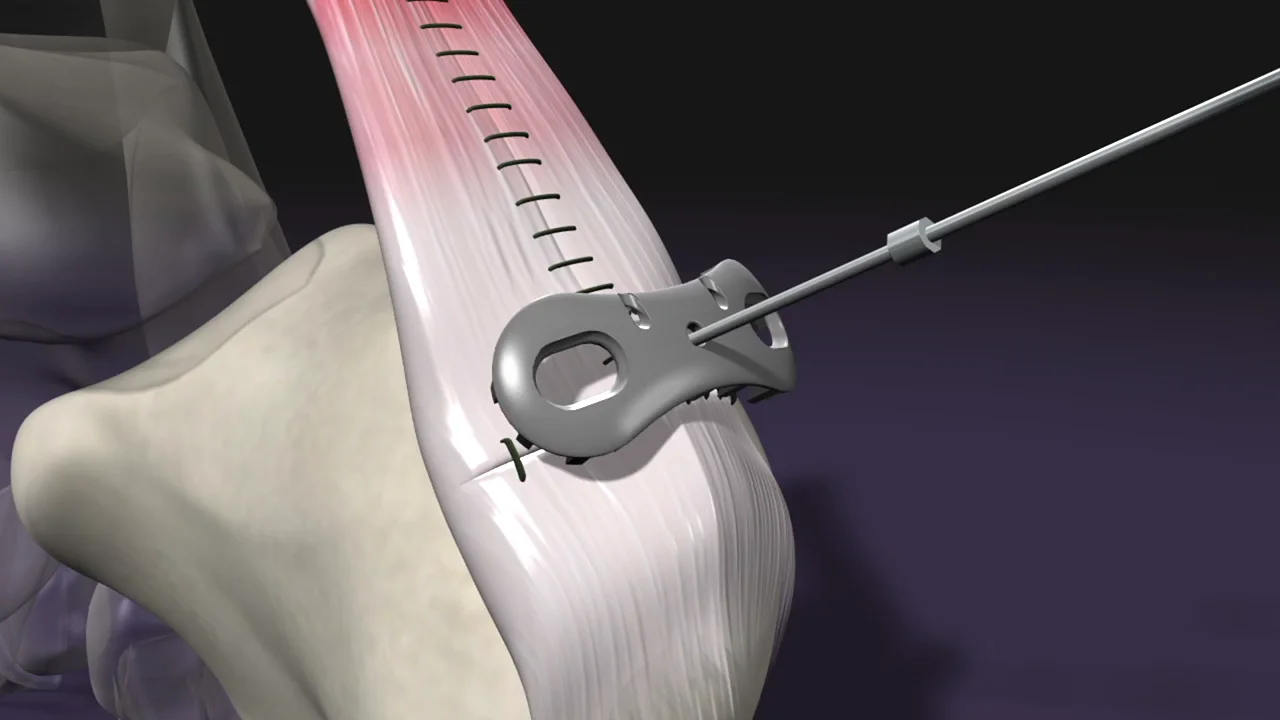 Tendon Anchor System Kidner and Haglunds Animation on Vimeo