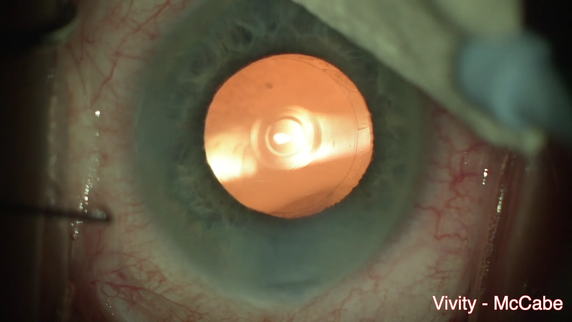 Vivity IOL light reflex by Cathleen McCabe, MD on Vimeo