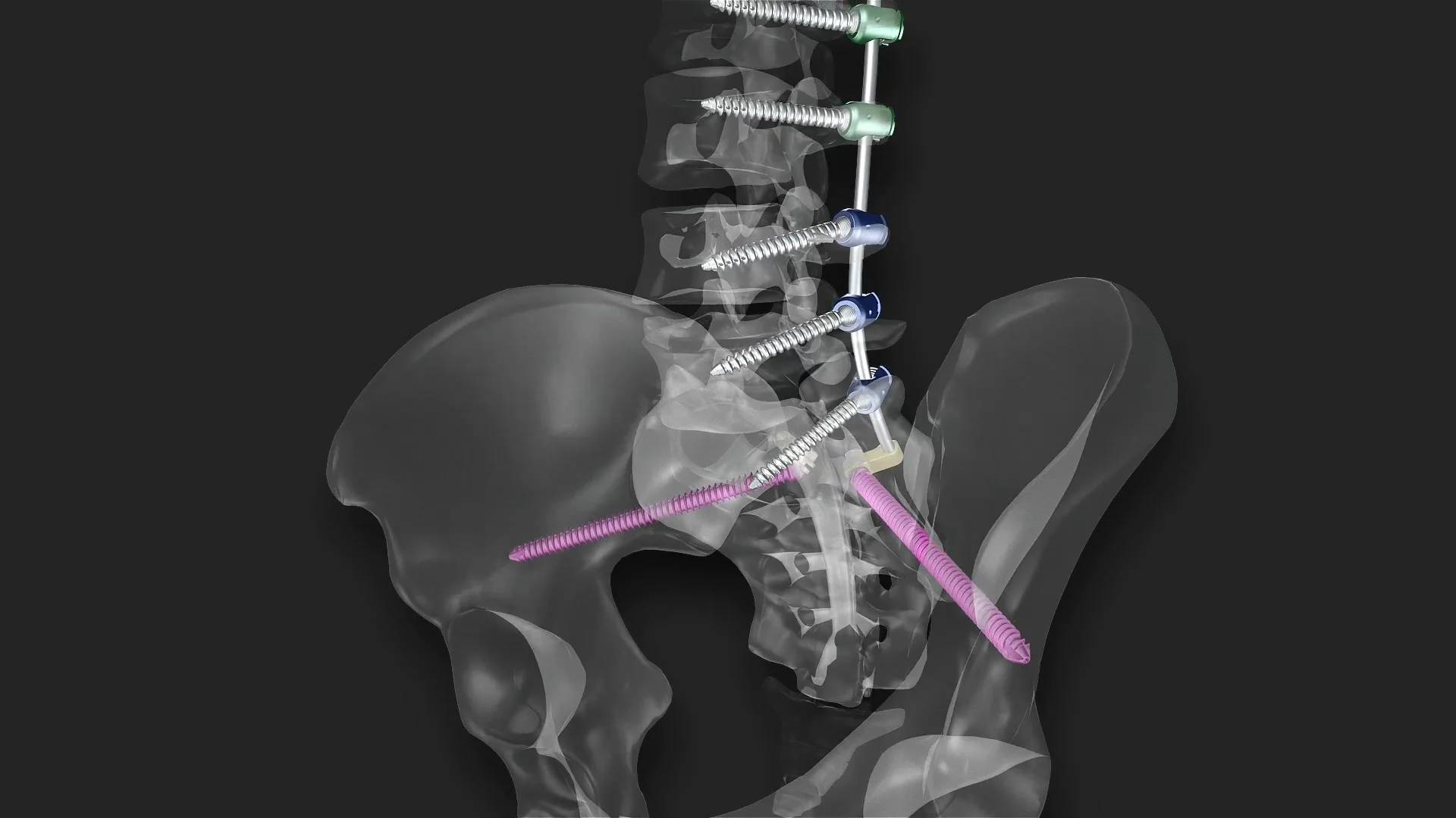 Sacroiliac screw placement