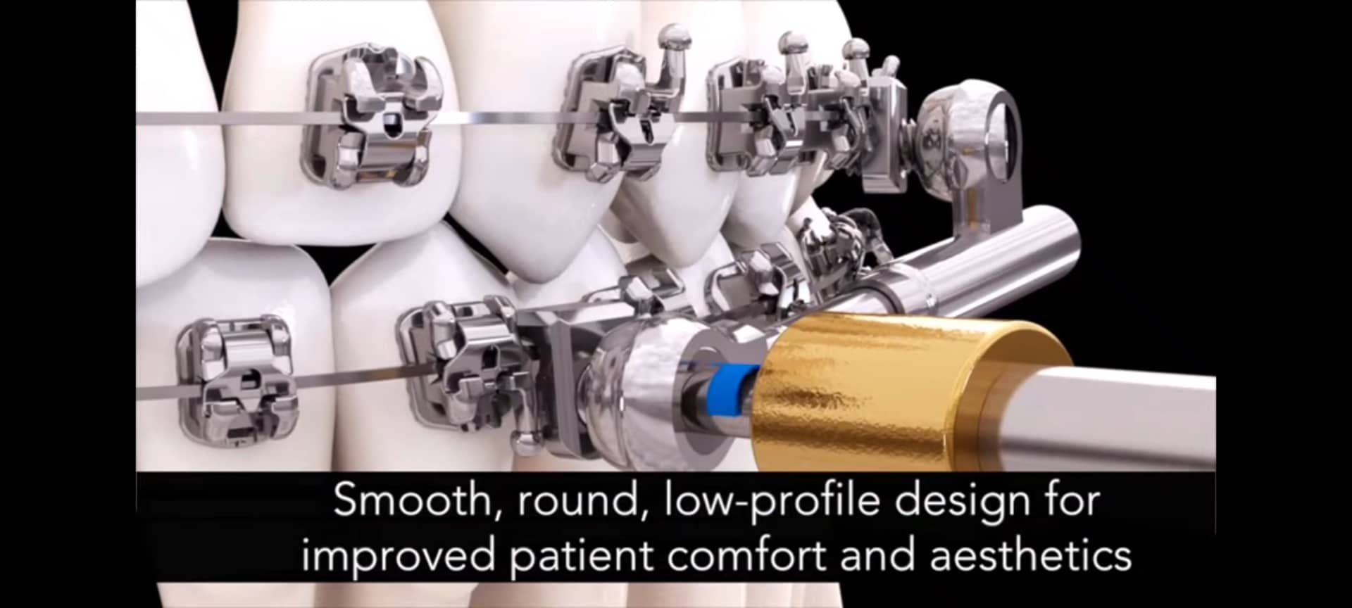 PowerScope™ 2 Class II Corrector on Vimeo