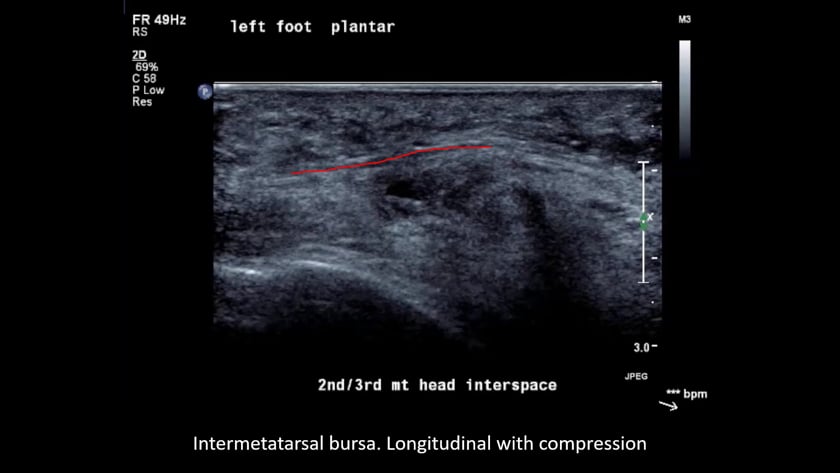 Foot Pathology ULTRASOUNDPAEDIA