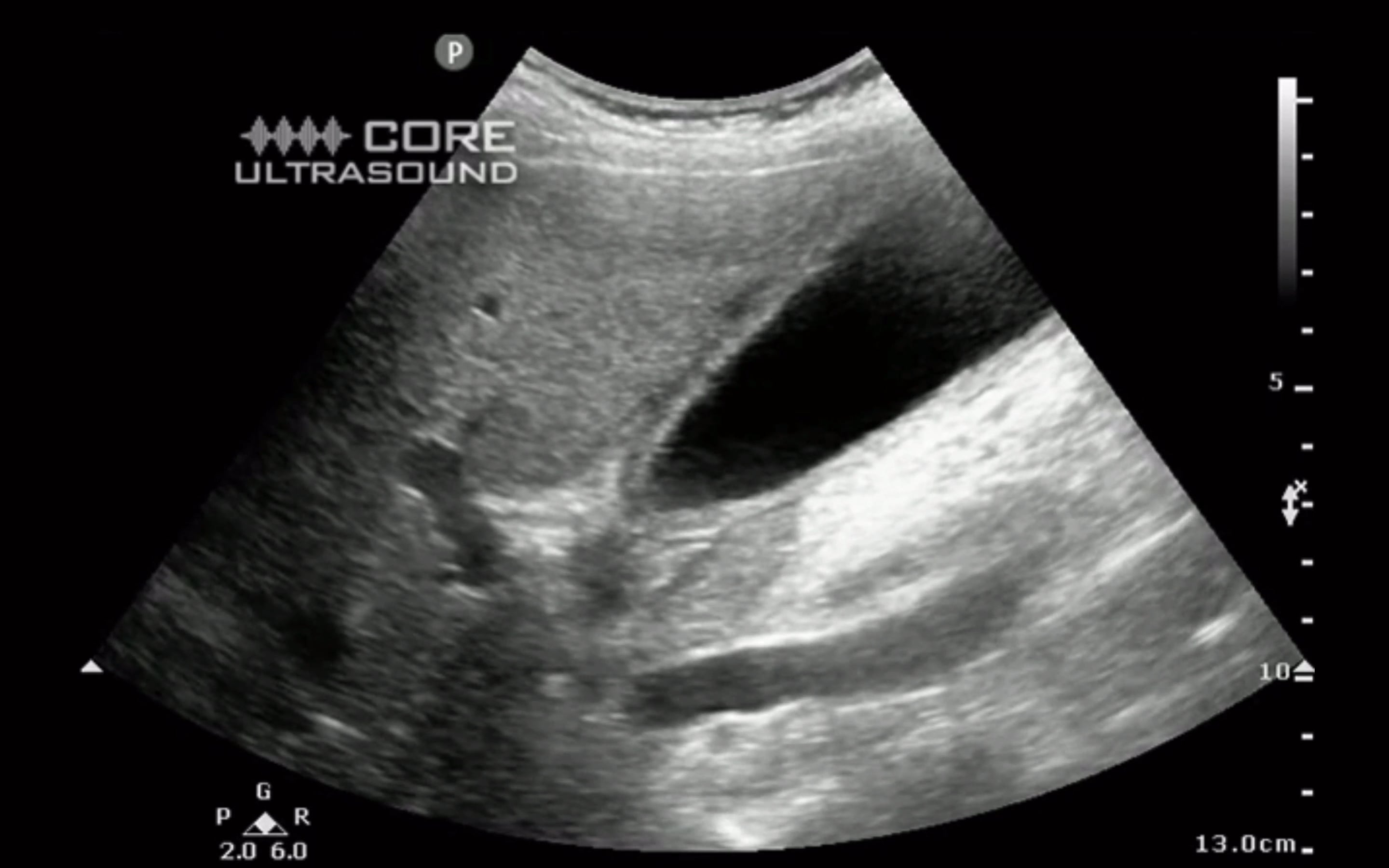 Gallbladder - Narration - Pericholecystitc fluid.mp4 on Vimeo