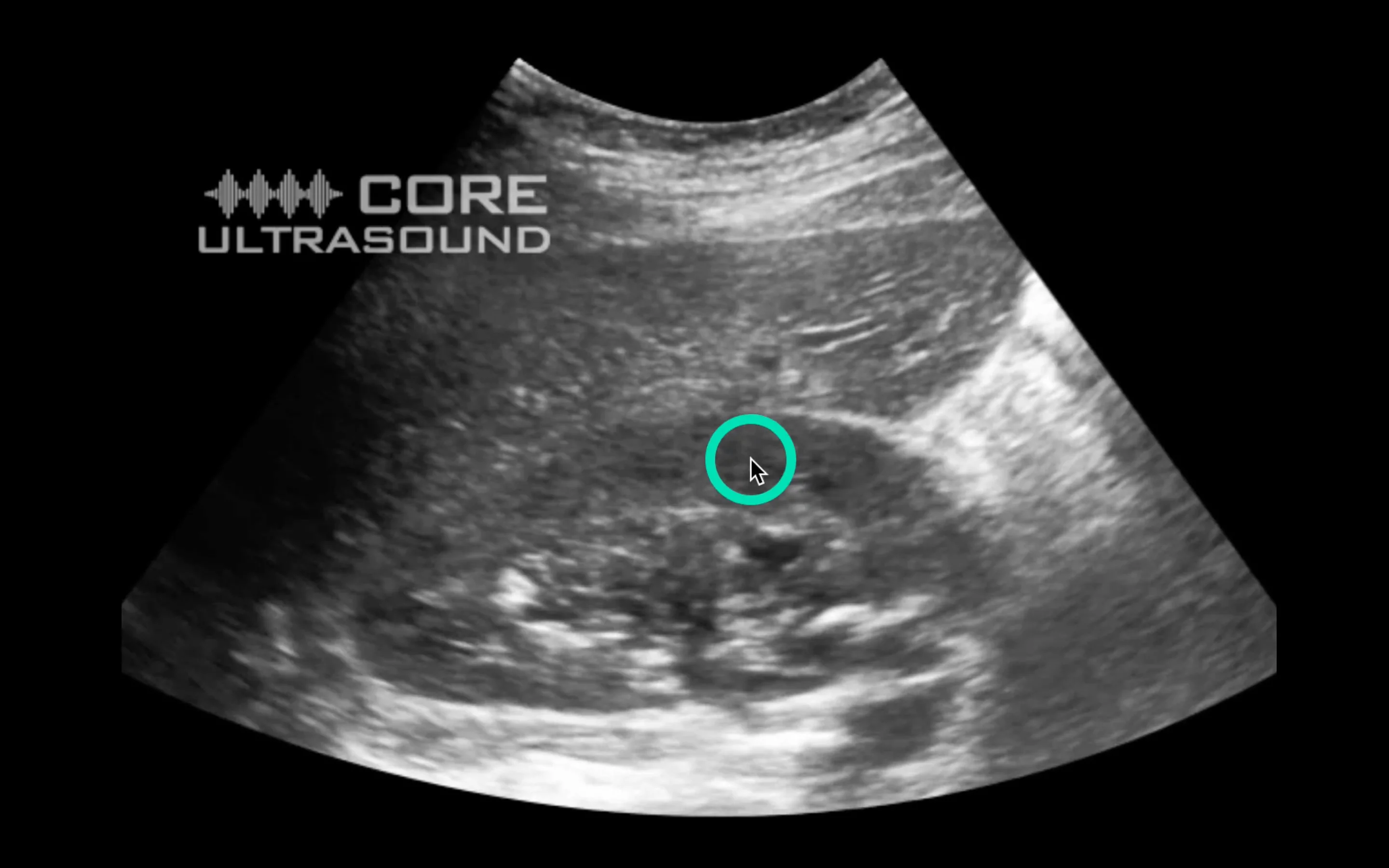 Renal Mild Hydro.mp4 on Vimeo