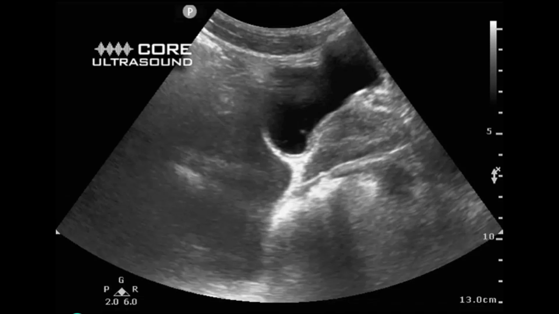 FAST Pelvis positive Narration.mp4