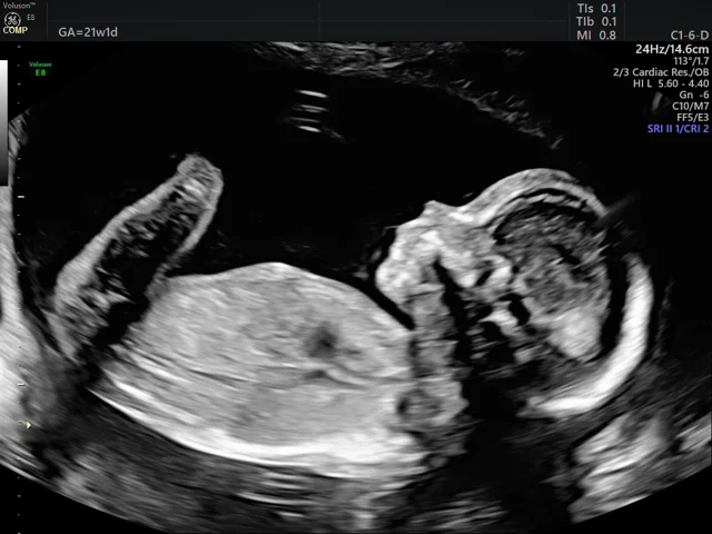 21 Weeks Ultrasound