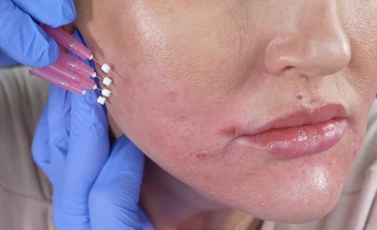 Lower Face Thread Lift on Vimeo