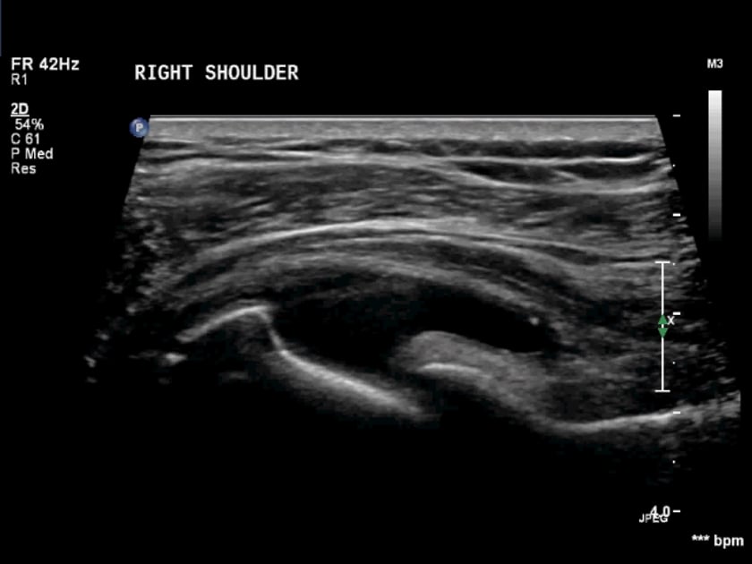 Shoulder pathology – ULTRASOUNDPAEDIA