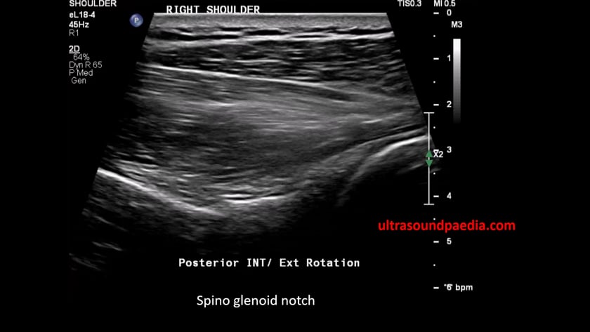 Shoulder pathology – ULTRASOUNDPAEDIA