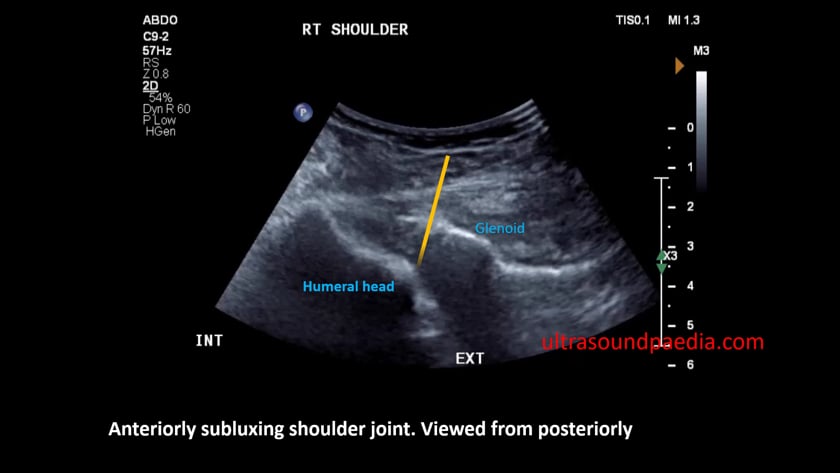 Shoulder pathology – ULTRASOUNDPAEDIA